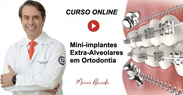 MINI-IMPLANTES EXTRA-ALVEOLARES EM ORTODONTIA - online - Sympla
