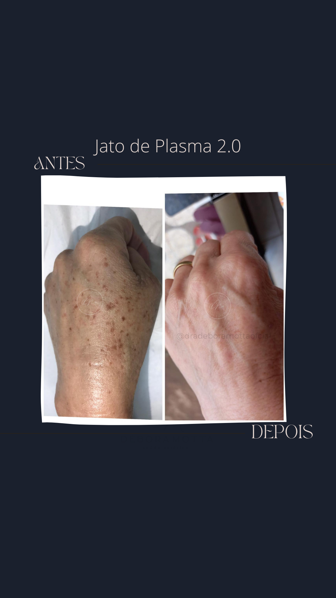 Imersão Jato de Plasma Associado a Harmonização Facial e Corporal em ...