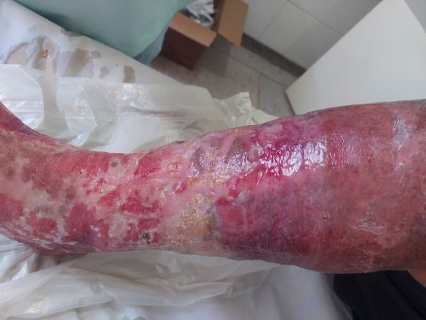 O melhor manejo para Feridas Infectadas- Edição 2 - online - Sympla